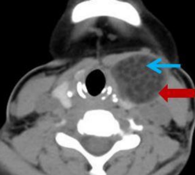 Typically appearing dermoid cyst of neck in atypical location - Krsnaa ...