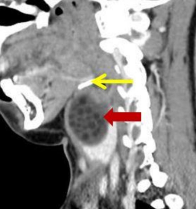 Typically appearing dermoid cyst of neck in atypical location - Krsnaa ...