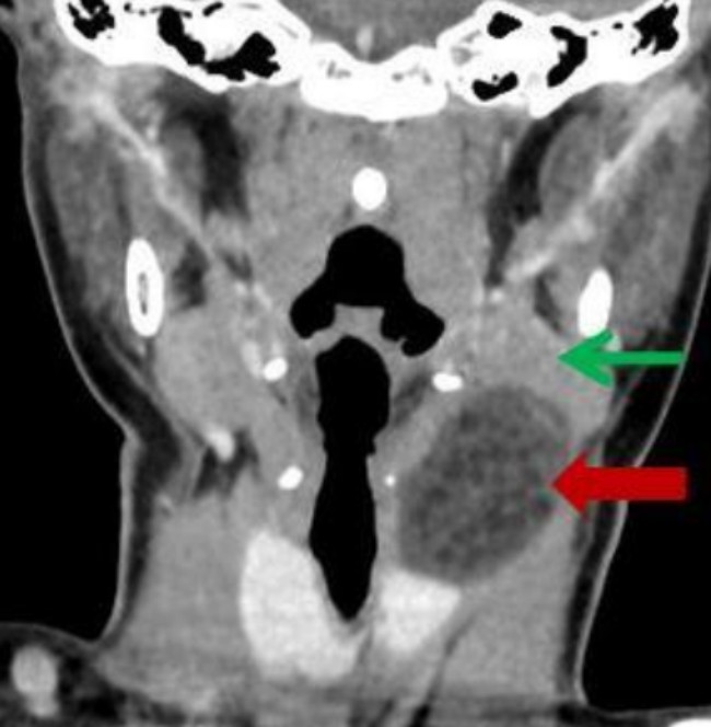 Typically appearing dermoid cyst of neck in atypical location - Krsnaa ...